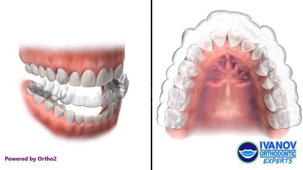 Understanding Invisalign Cost: Your Path to a Clearer Smile